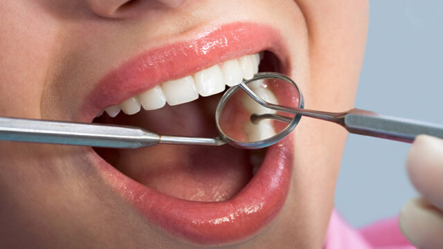 Dental Clinics in Singapore for Teeth Filling, Scaling and X-Rays