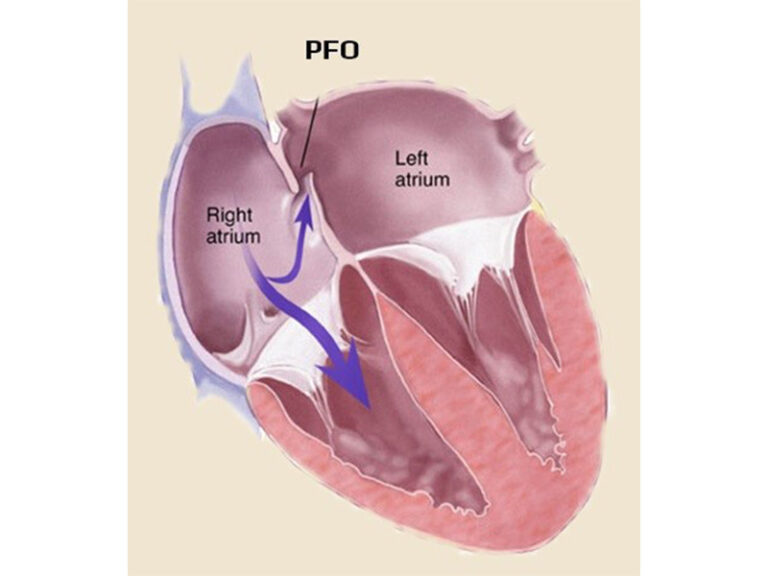 What Causes Migraine - Could a Hole in the Heart Be the Reason?